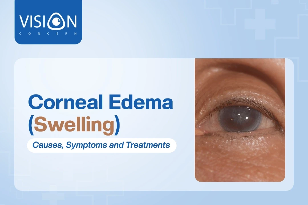 Corneal Edema (Swelling): Causes, Symptoms & Treatment