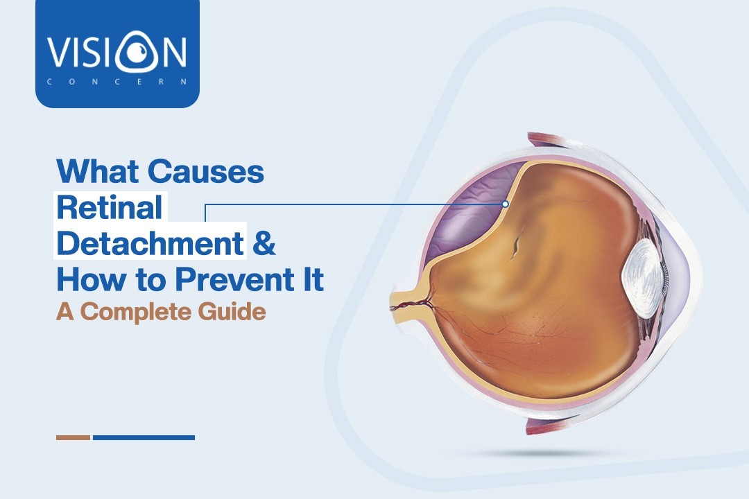 Retinal Detachment: Causes, Symptoms, and Prevention Tips
